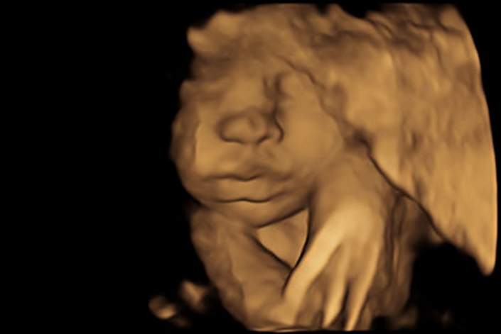 3D/4D ultrasound